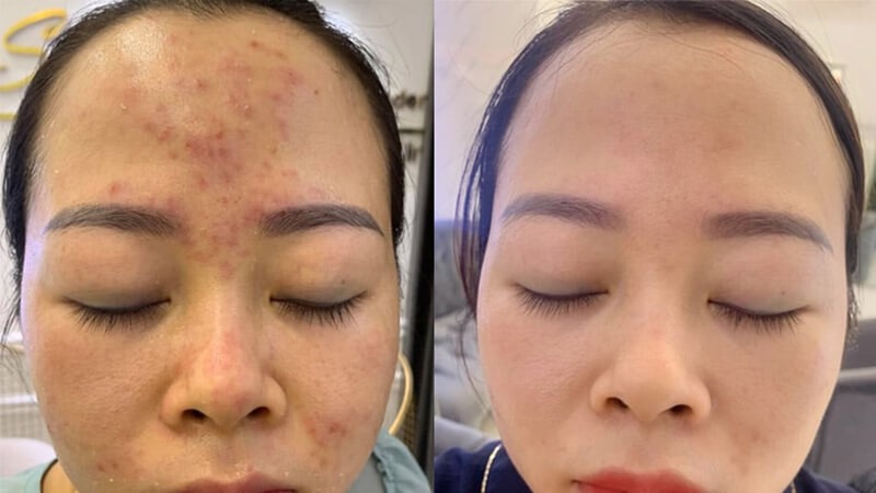 Tìm hiểu về phương pháp vi kim tảo biển và những lợi ích cho làn da | KhaiStore.vn